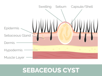 How to Treat Sebaceous Cysts on Cats: Our Vet Answers (With Infographic ...